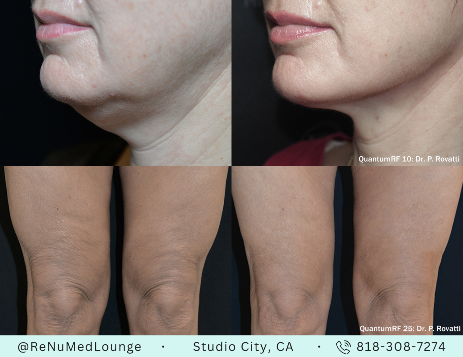 Unlock the Power of Quantum RF: Revolutionary Skin Tightening & Contouring at ReNu Med Lounge ...