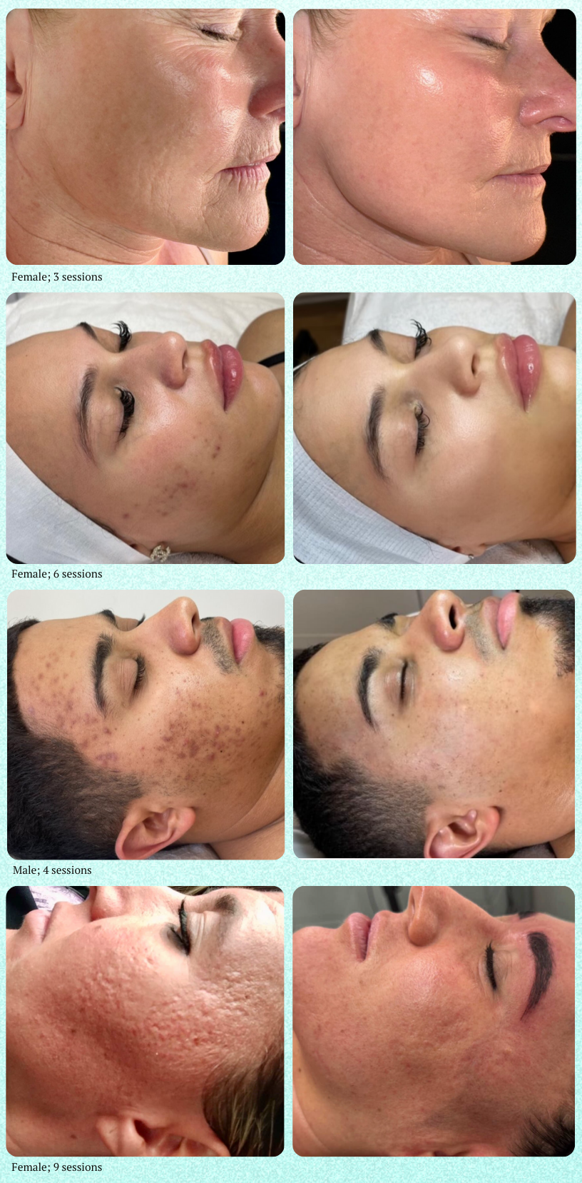 Radiant Skin with SkinPen Elite Microneedling - ReNu Med Lounge Corp.