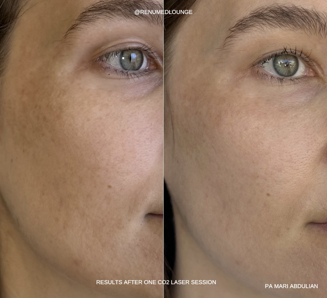 Pixel Peel CO2 for Hyperpigmentation: A Powerful Skin Resurfacing ...